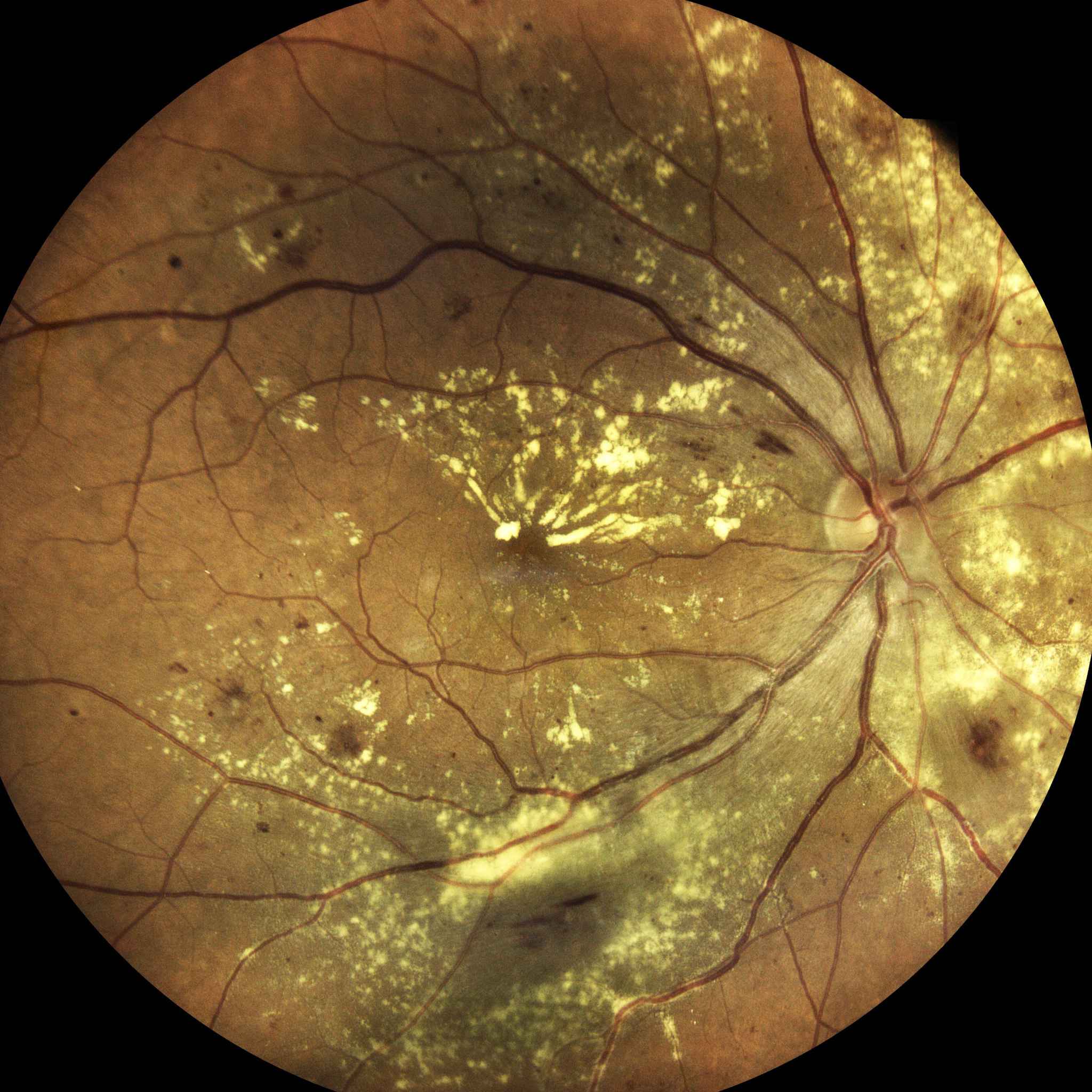 Creating an ‘atlas’ of the macula - Macular Society