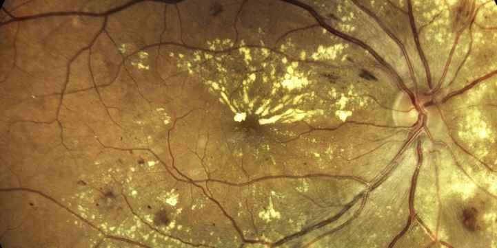 Are we a step closer to treating AMD with red light? - Macular Society