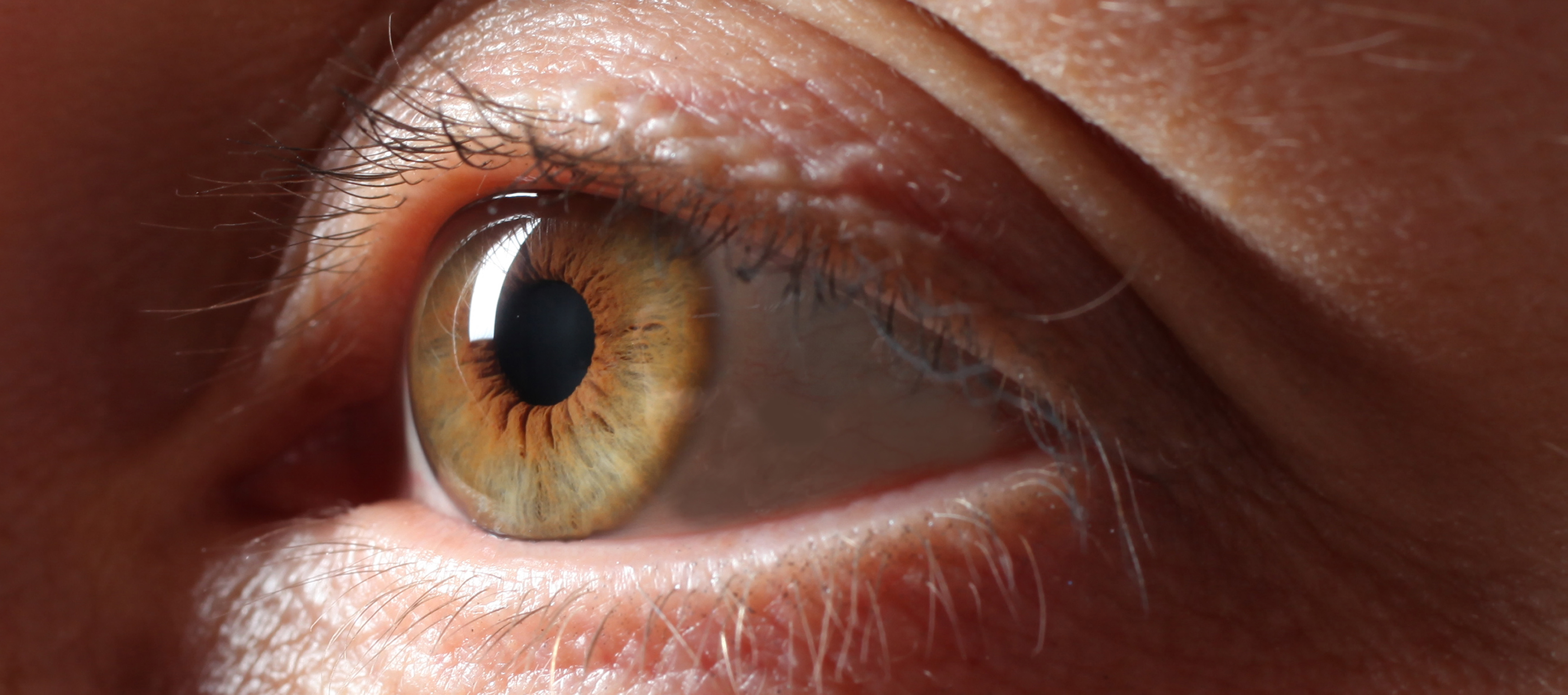 Cone dystrophy - Macular Society