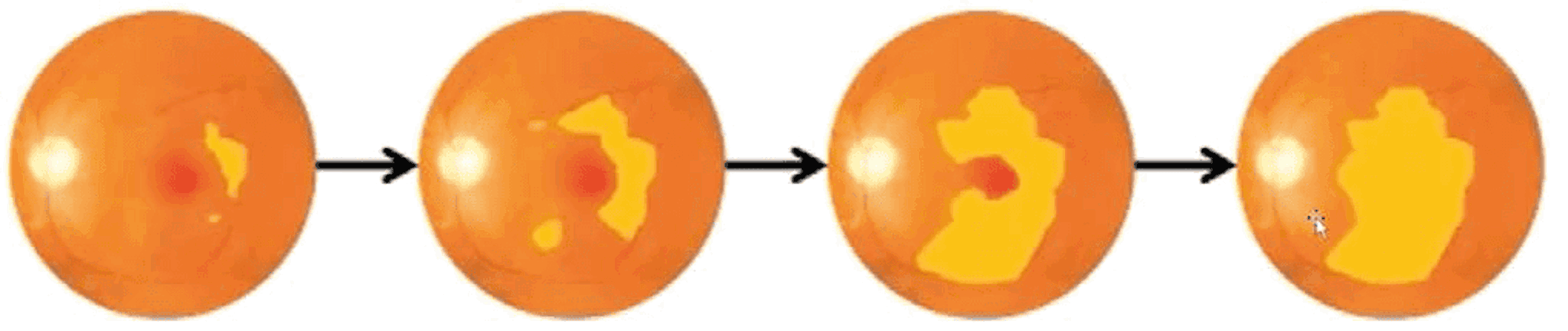 What is geographic atrophy? - Macular Society